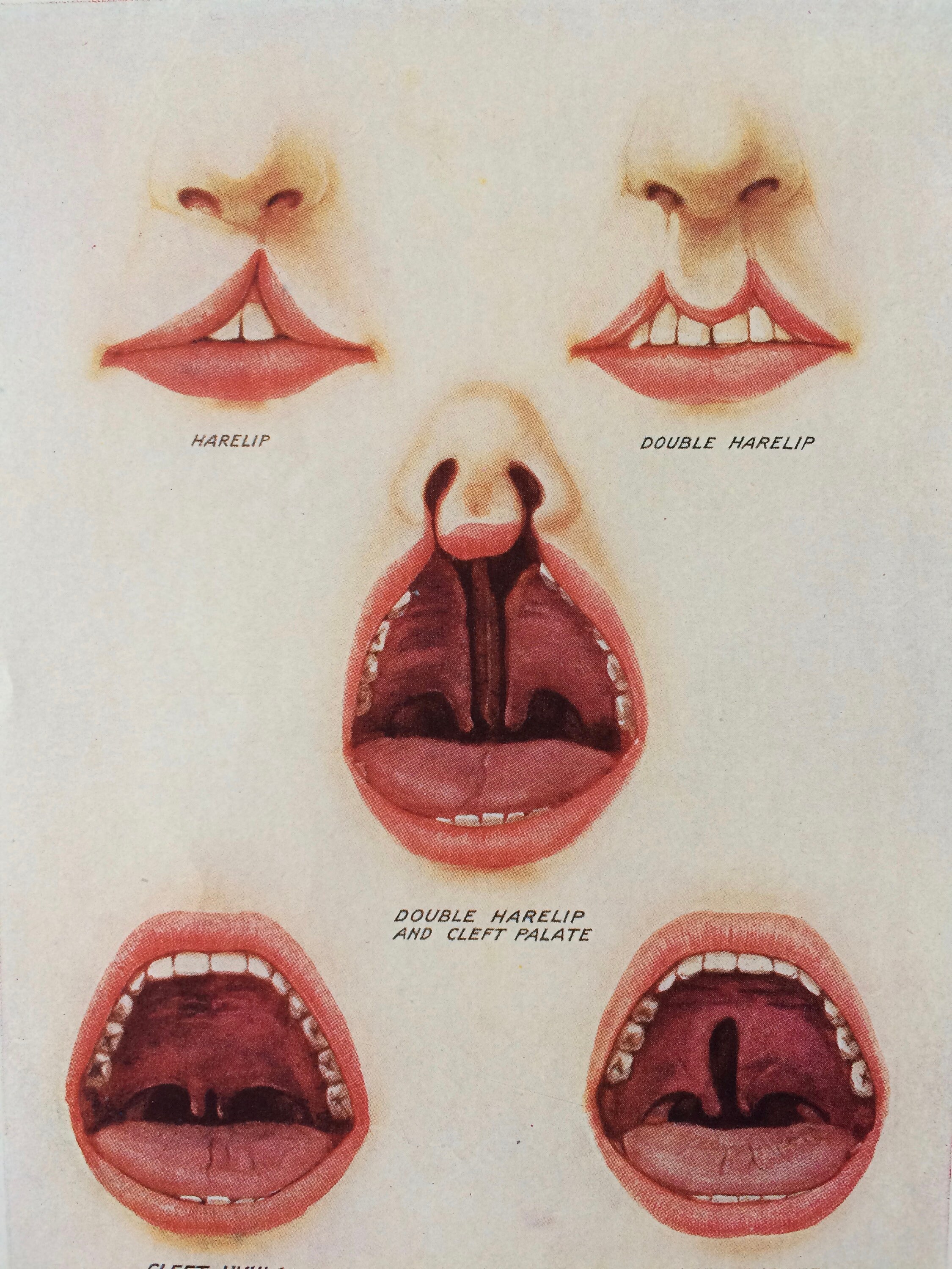 1920s Original Antique Matted Anatomical Print - Varieties of Hare-Lip ...