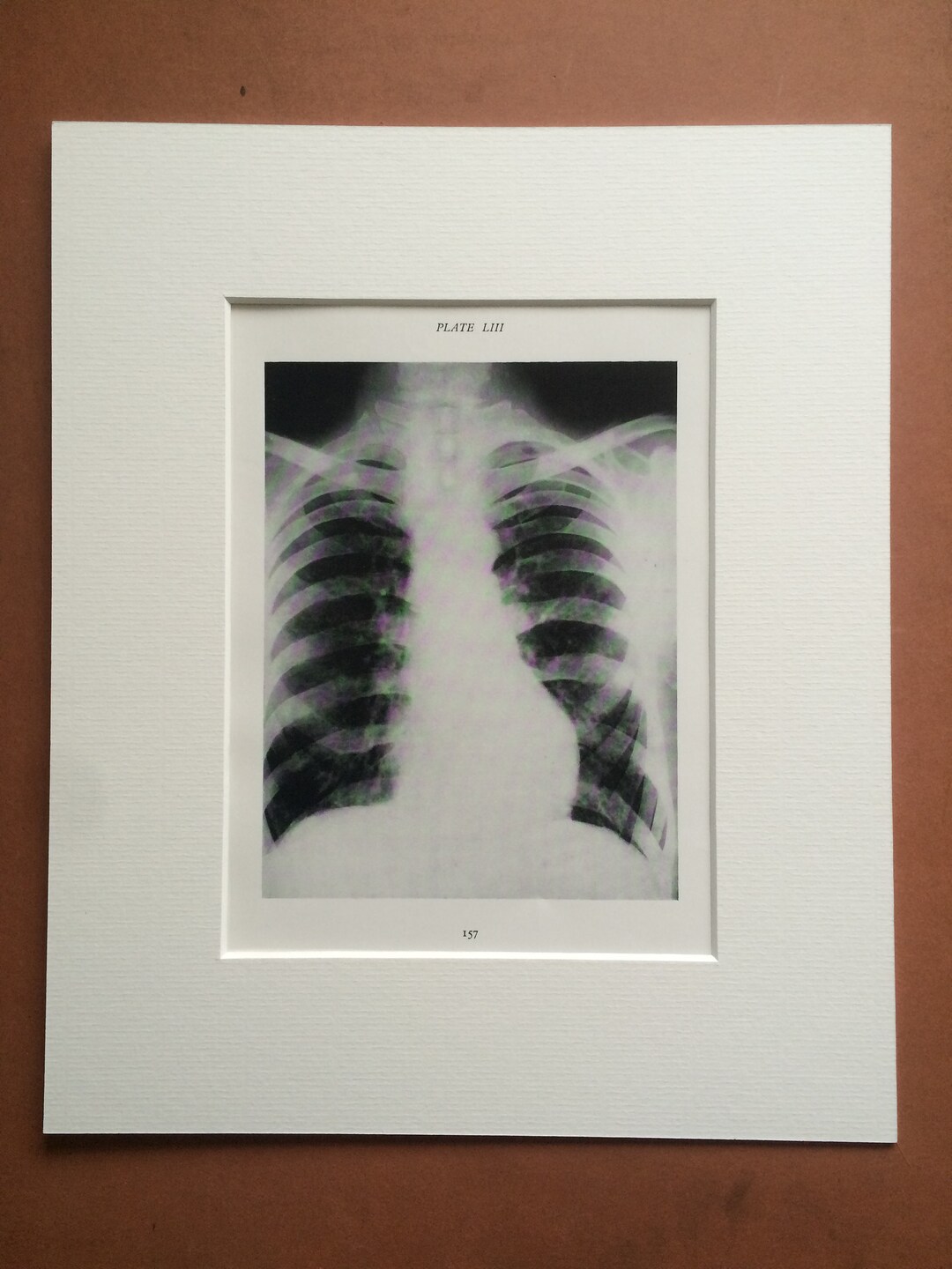 1941 Chest & Lung X-ray Original Vintage Print Mounted and - Etsy