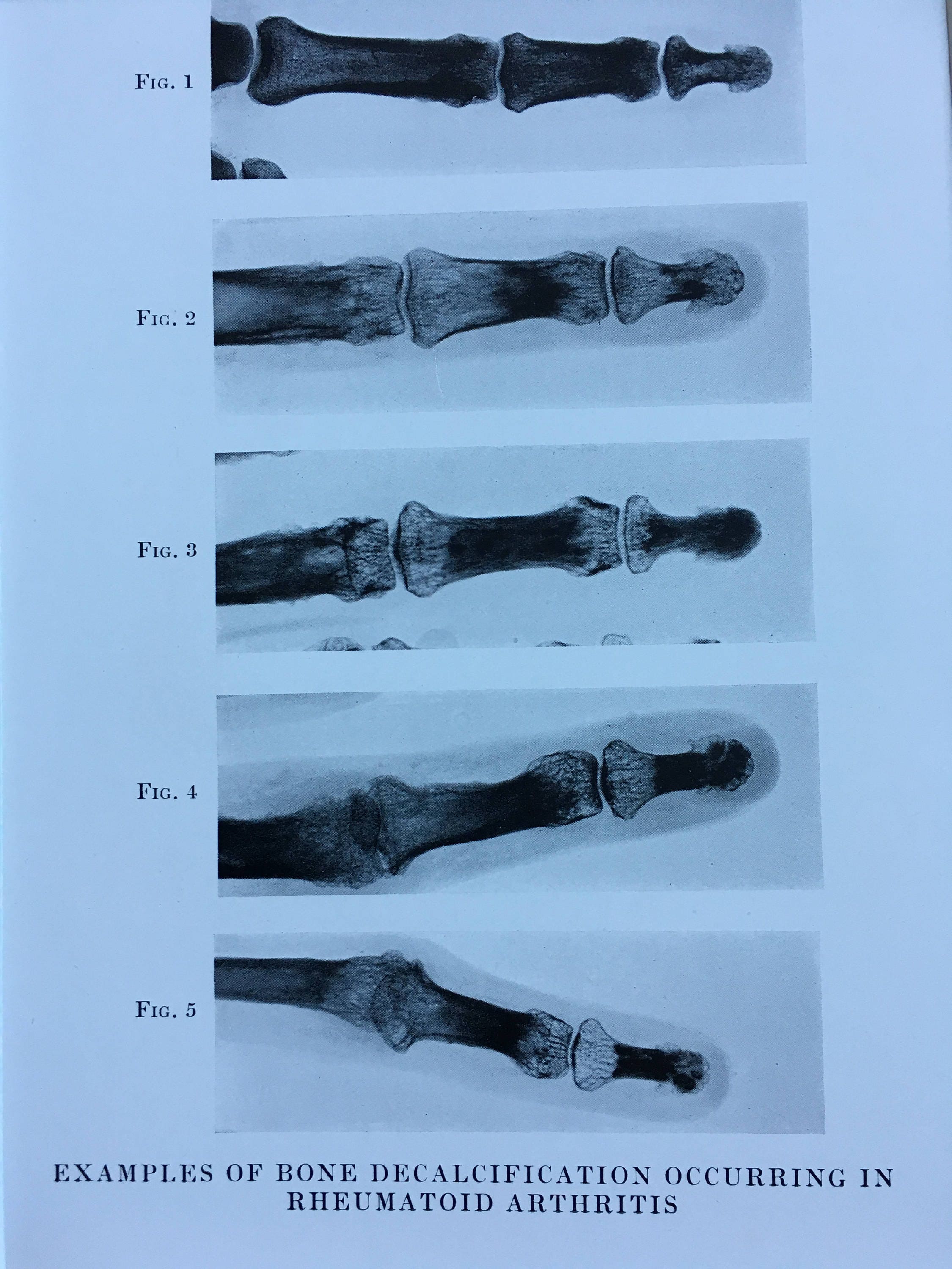 1935 Bone Decalcification Original Vintage Print - Available Framed ...