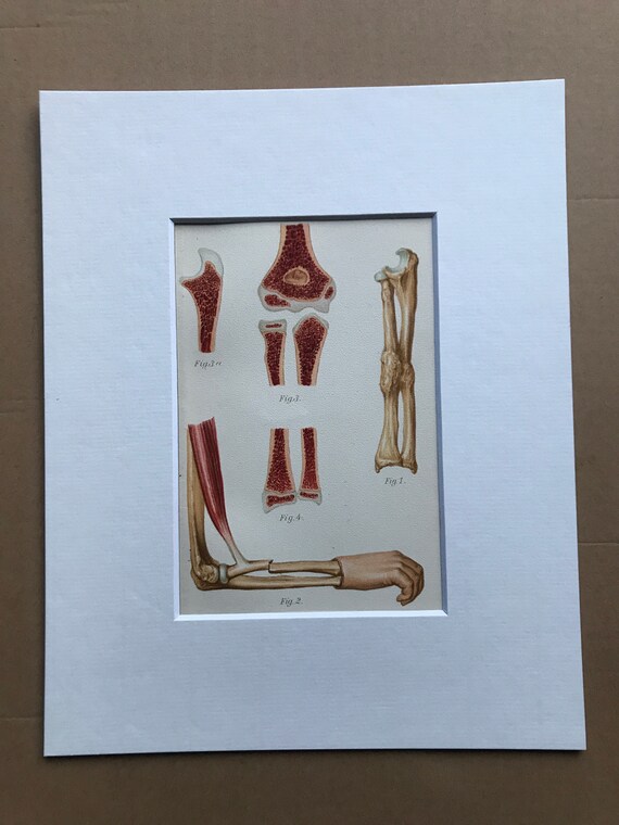 Art & Collectibles 1902 Forearm Dislocation Original Antique Anatomical ...
