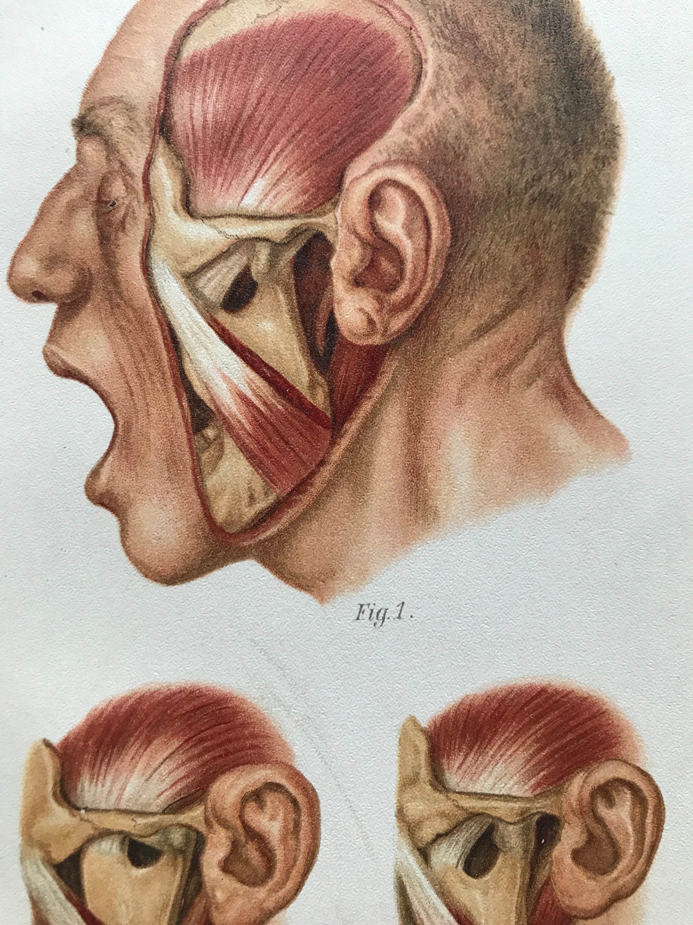 1902 Lower Jaw Dislocation Original Antique Anatomical Print ...