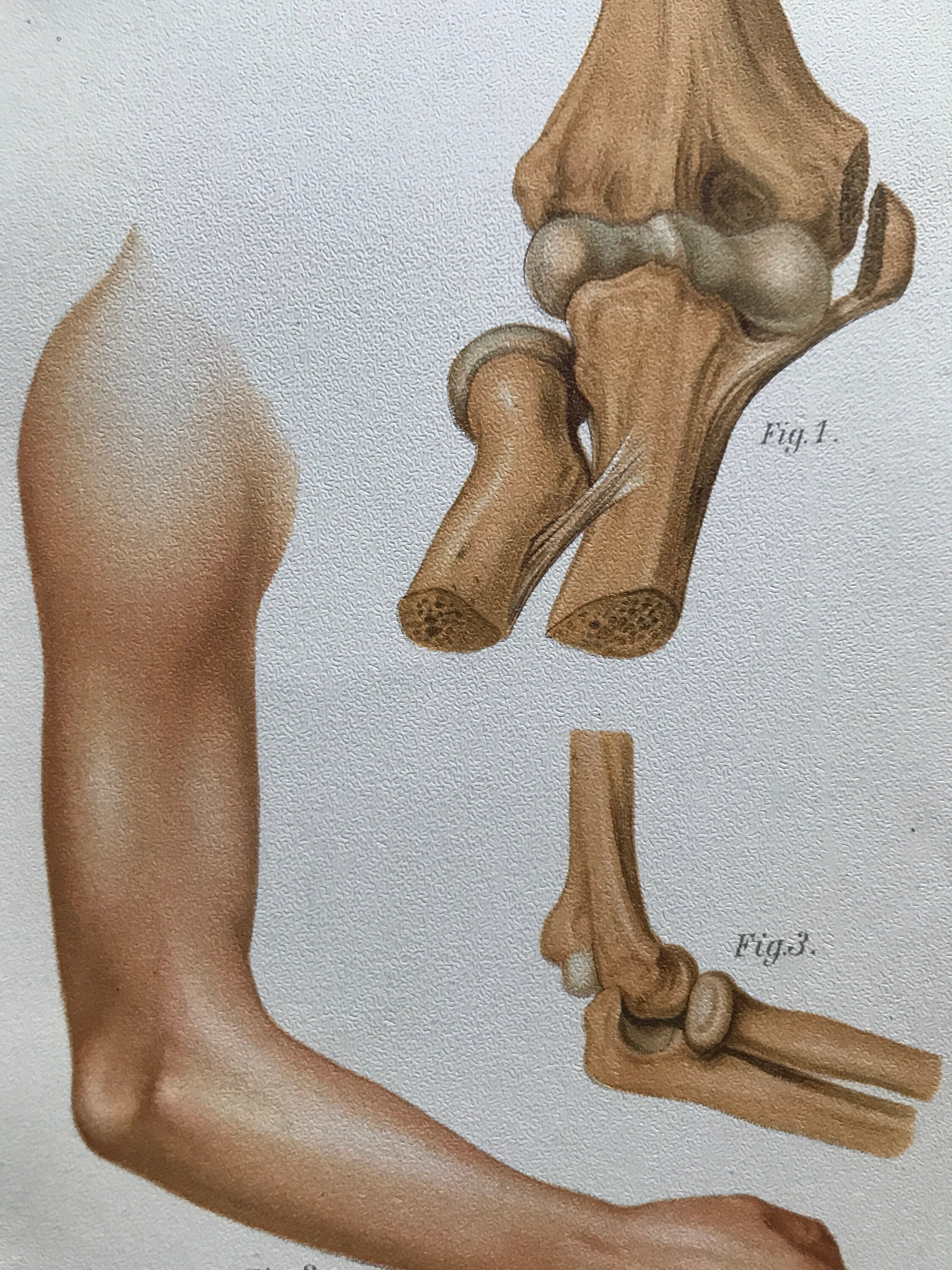 Art & Collectibles 1902 Forearm Dislocation Original Antique Anatomical ...