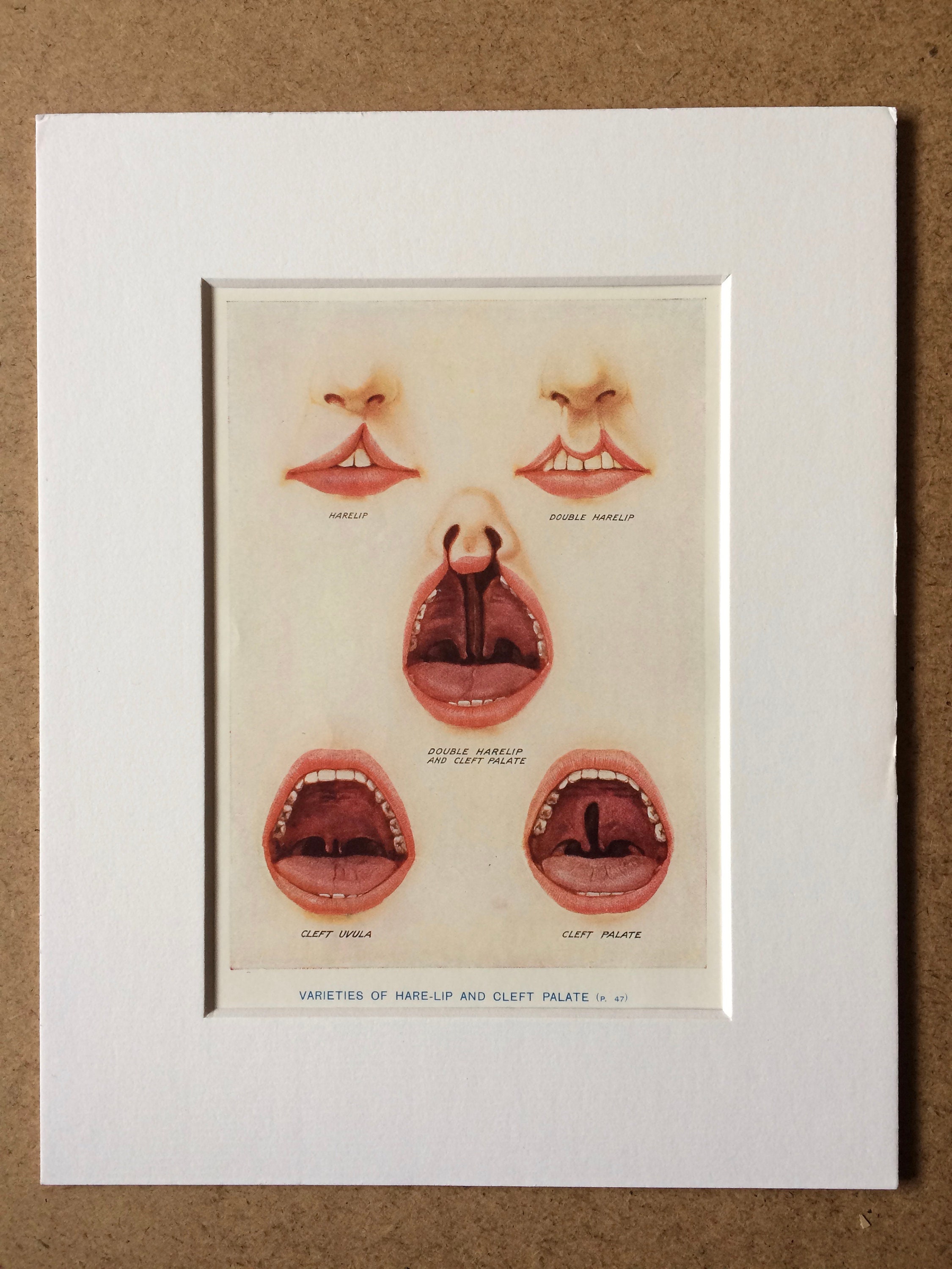 1920s Original Antique Matted Anatomical Print - Varieties of Hare-Lip ...