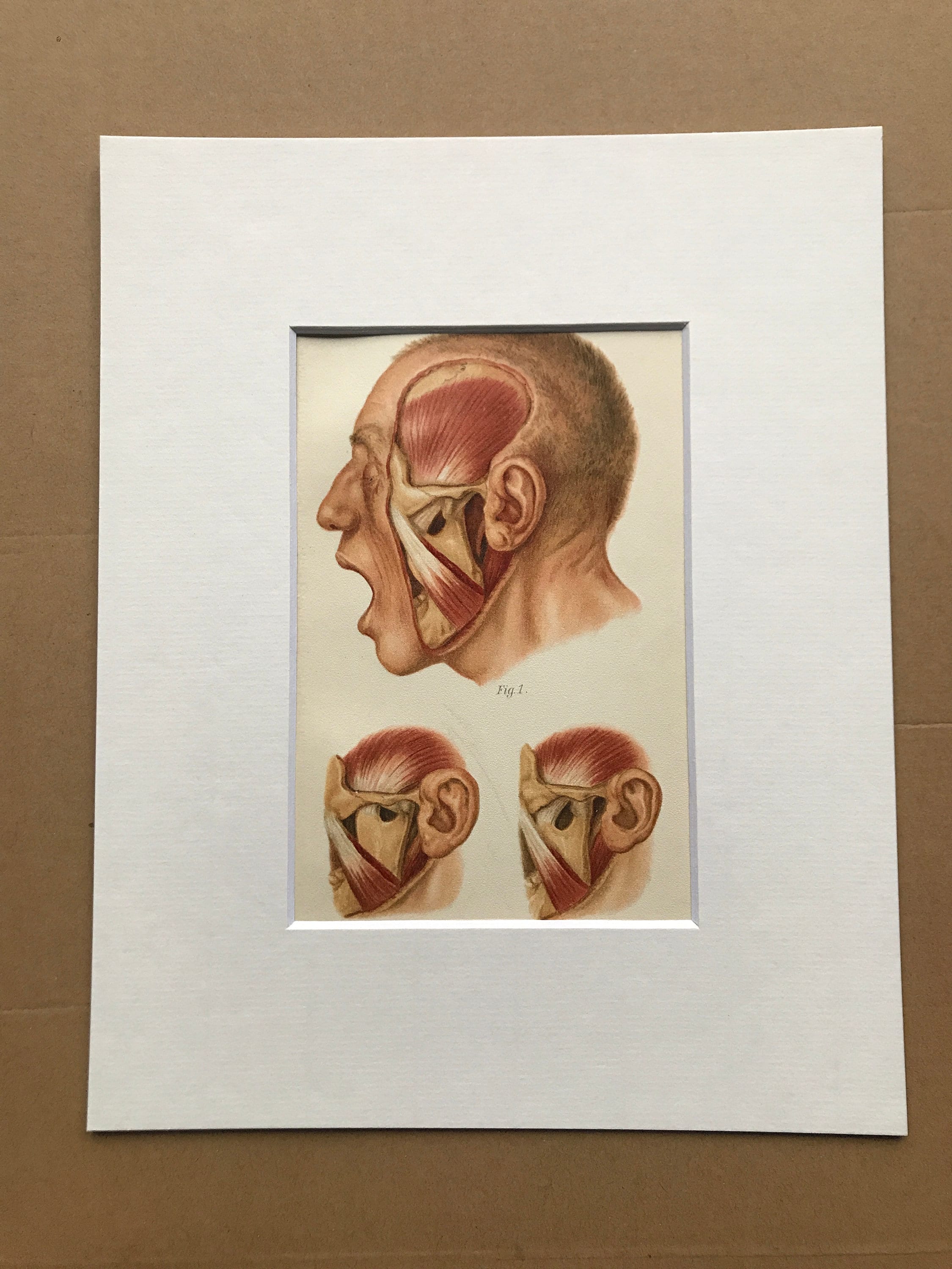 1902 Lower Jaw Dislocation Original Antique Anatomical Print ...