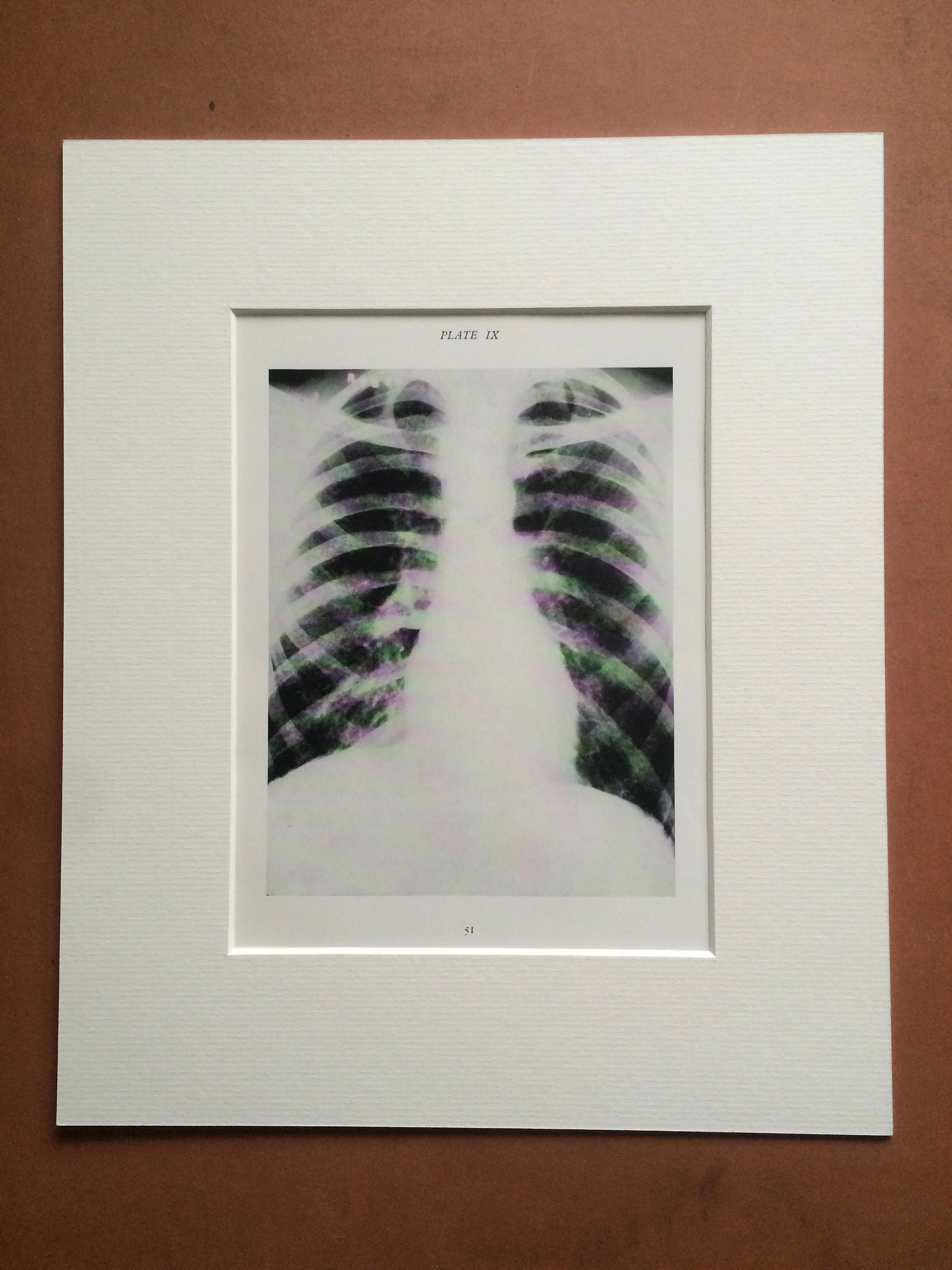 1941 Chest & Lung X-Ray Original Vintage Print - Mounted and Matted ...