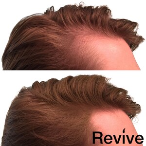 Revive 25g Bottle of Hair Building Fibers Hair Loss Concealer - Etsy