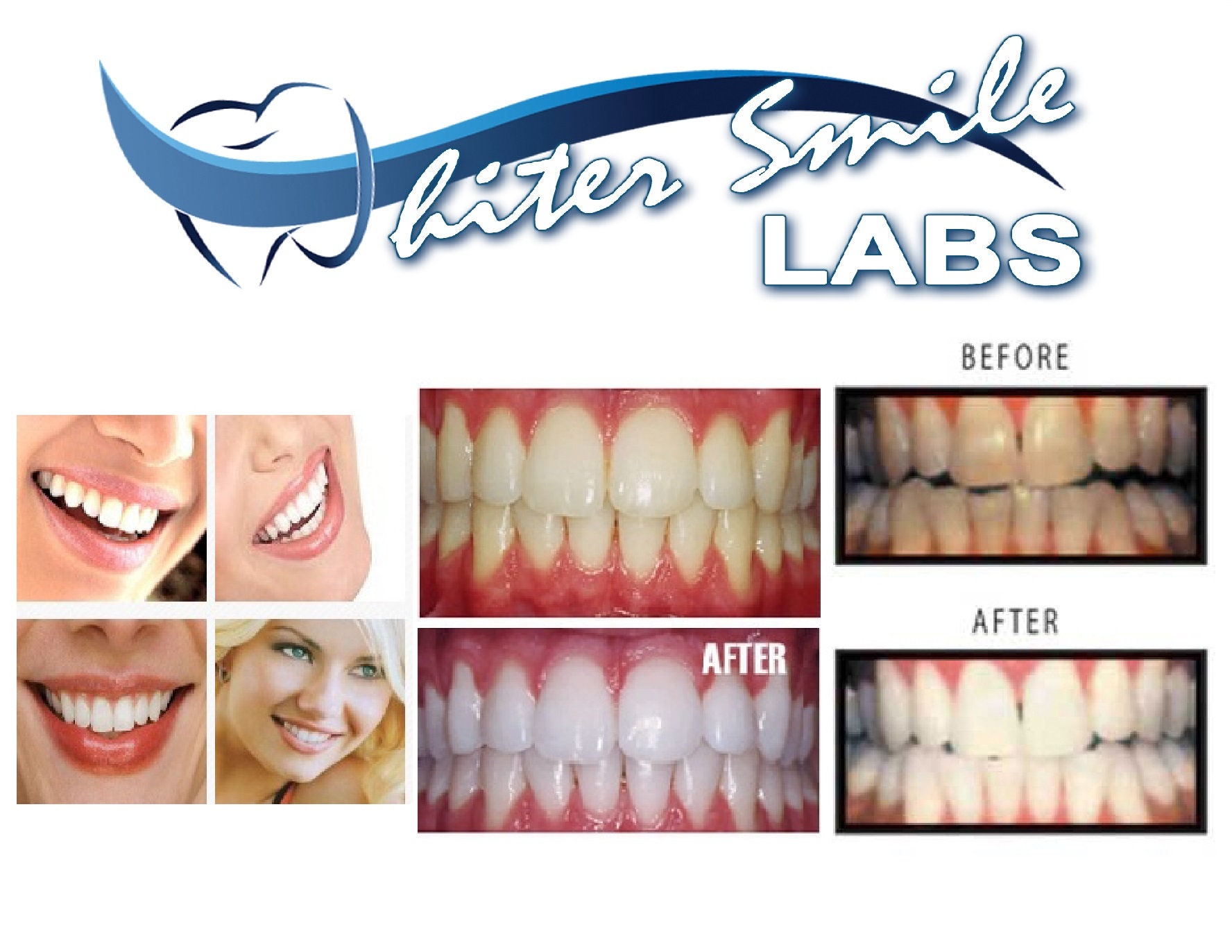 Pro Teeth Whitening Kit - 38% High Intensity Teeth Whitening Gel and ...