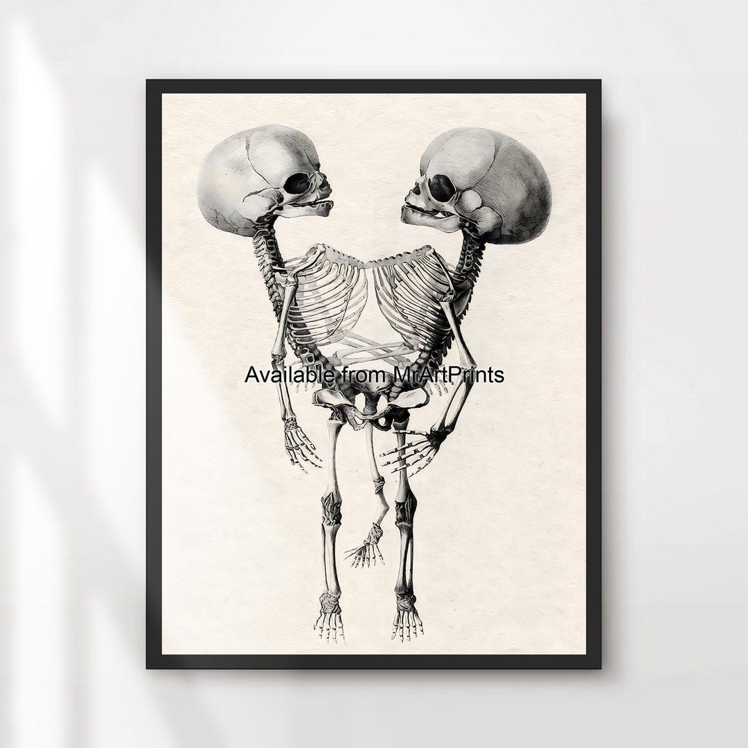 Conjoined Siamese Twins Skeleton Creepy Medical Art Print Poster Wall ...