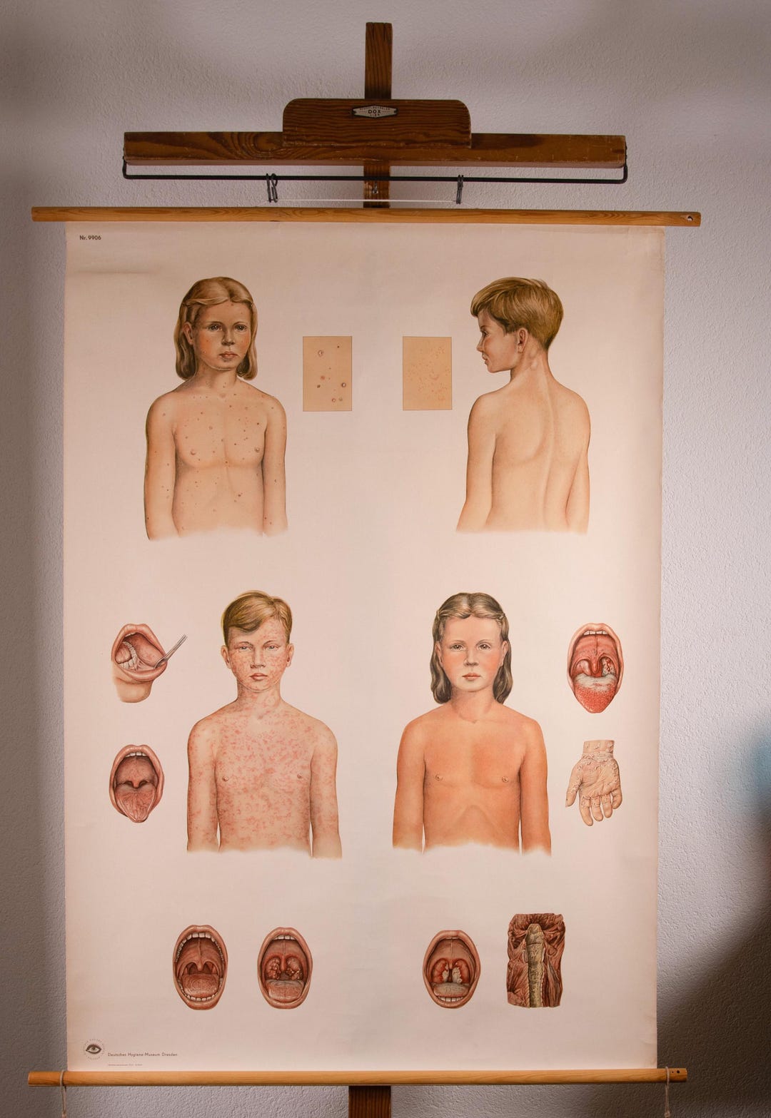 Vintage Pull Down Chart Infections in Children School Chart - Etsy