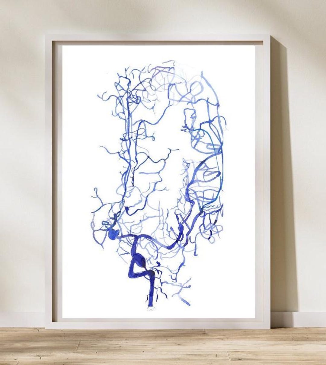 Brain Aneurysm Print, Cerebral Aneurysm Art Print, Angiogram, Radiology ...