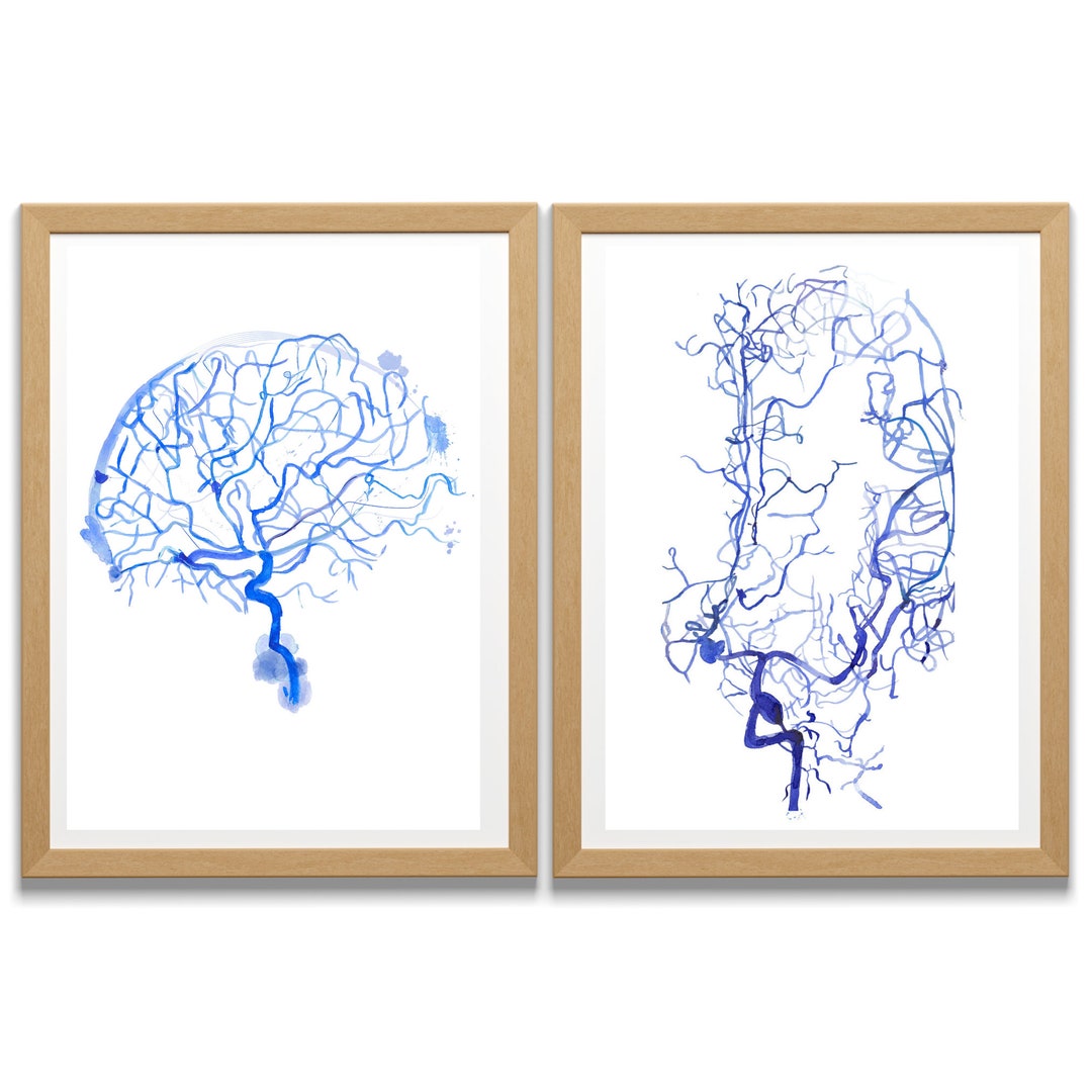 Cerebral Angiography, Cerebral Aneurysm, Set of 2, Brain Anatomy ...