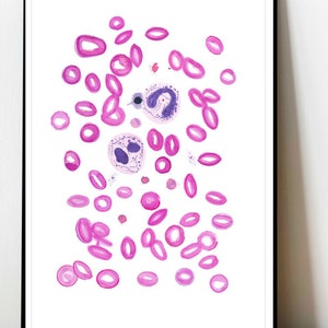 Sickle Cell Anaemia, Anemia Art, Hematology Art, Hematologist Gift ...