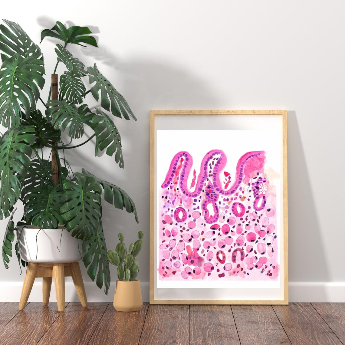 Stomach Signet Ring Cell Carcinoma, Pathology Art, Histopathology Print ...