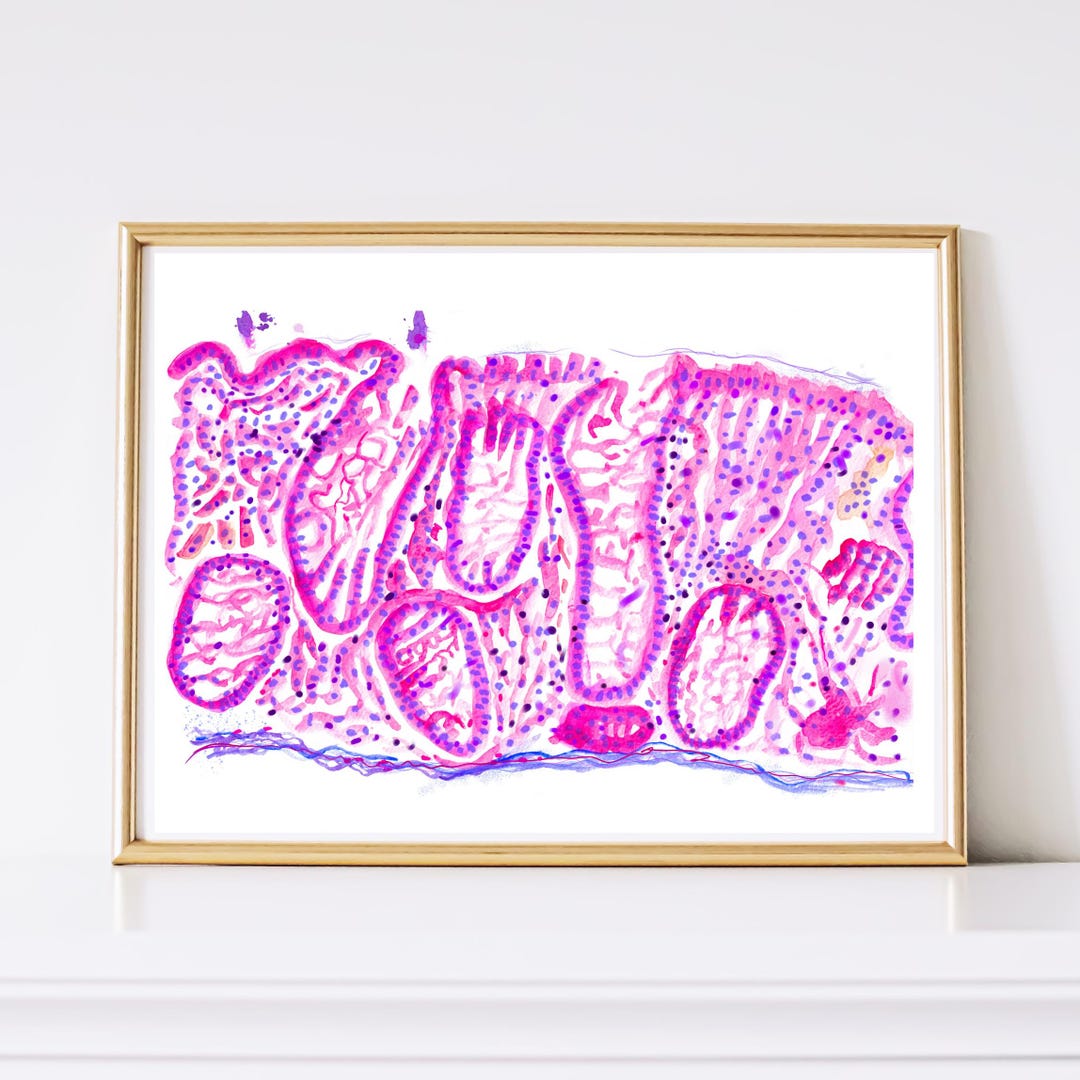 Crohn's Disease, Pathology Art, Histology Artwork, Pathologist Gift ...