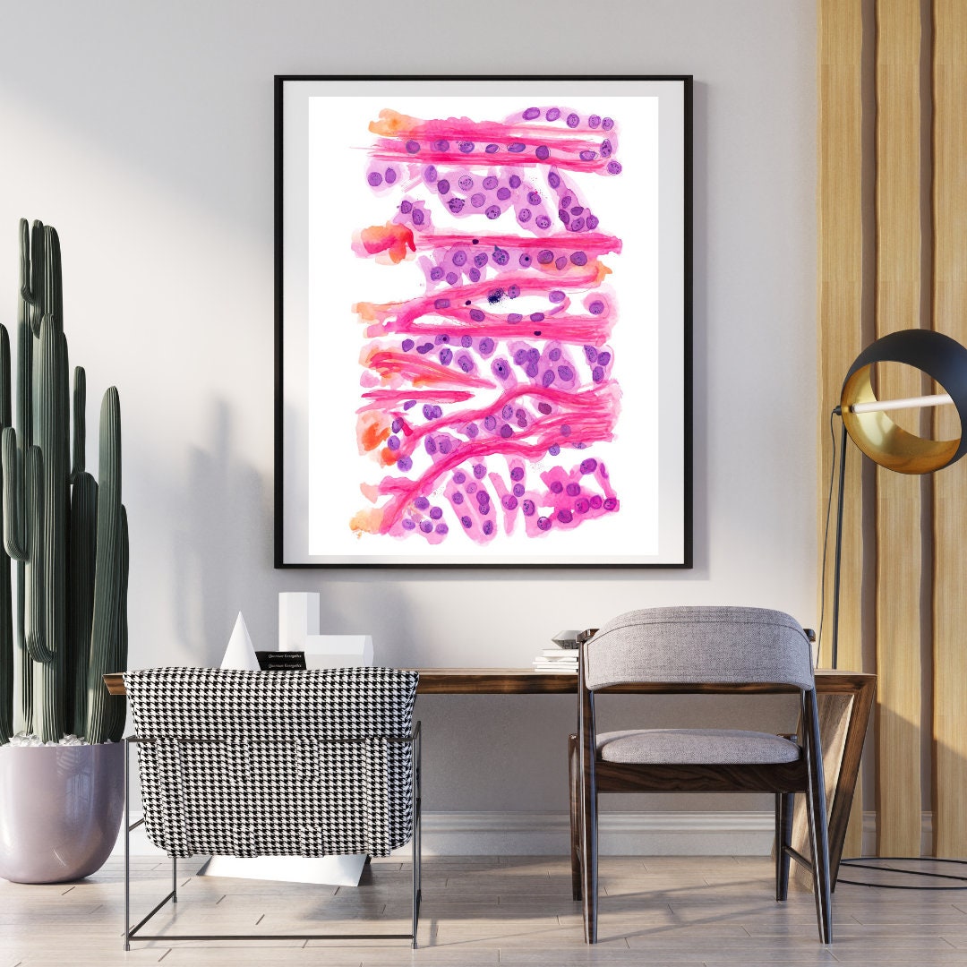 Melanoma Nevus, Skin Histology, Pathology Art, Gift for Pathologist ...