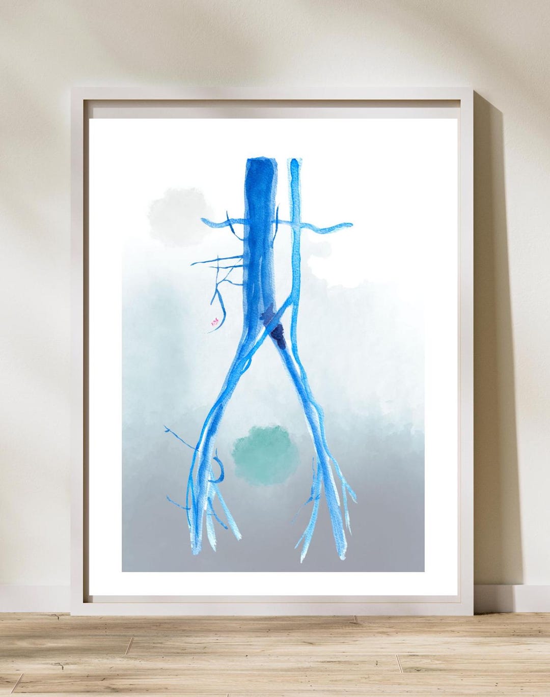 May-thurner Syndrome Venography, Interventional Radiology Art ...