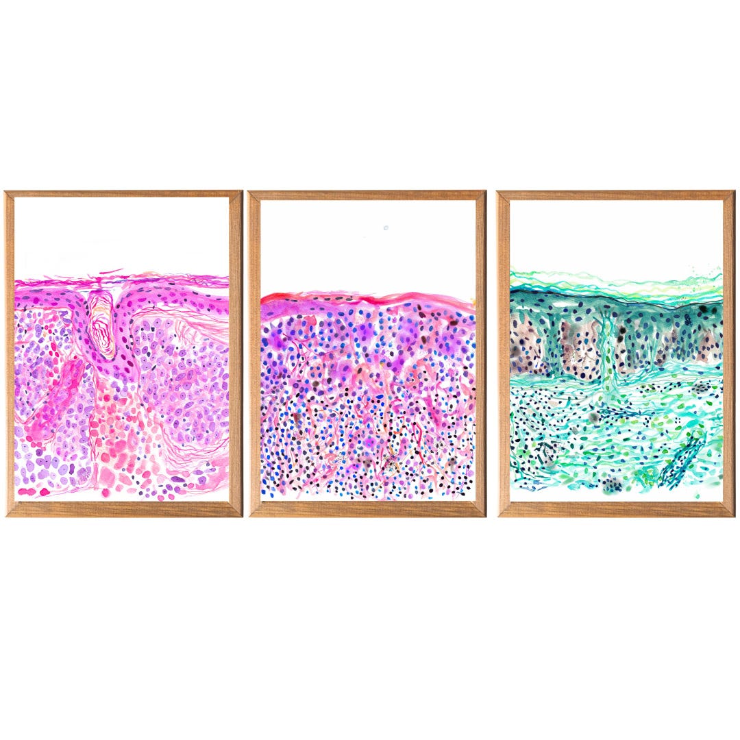 Skin Histology Art - Melanoma and Basal Cell Carcinoma Pathology ...