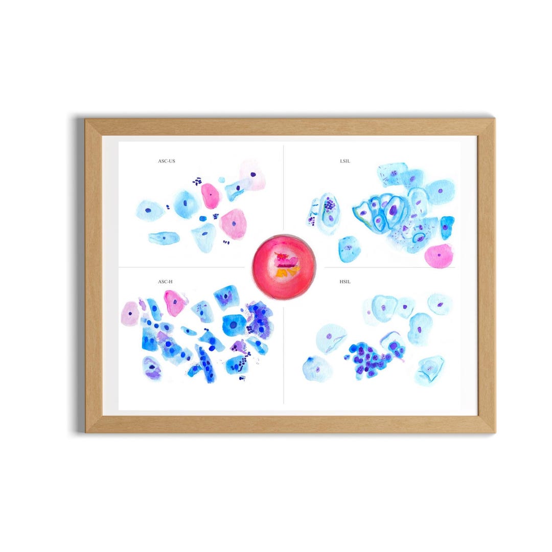 Cervix Cytology, Abnormal Pap Smear, Pathology Art, Histopathology Art ...
