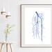 Popliteal Tibial Angiography, Lower Limb DSA, Radiology Art Print ...