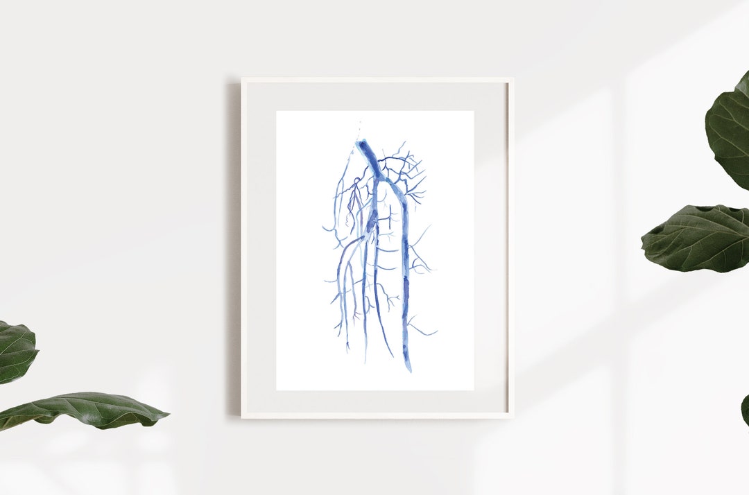 Popliteal Tibial Angiography, Lower Limb DSA, Radiology Art Print ...