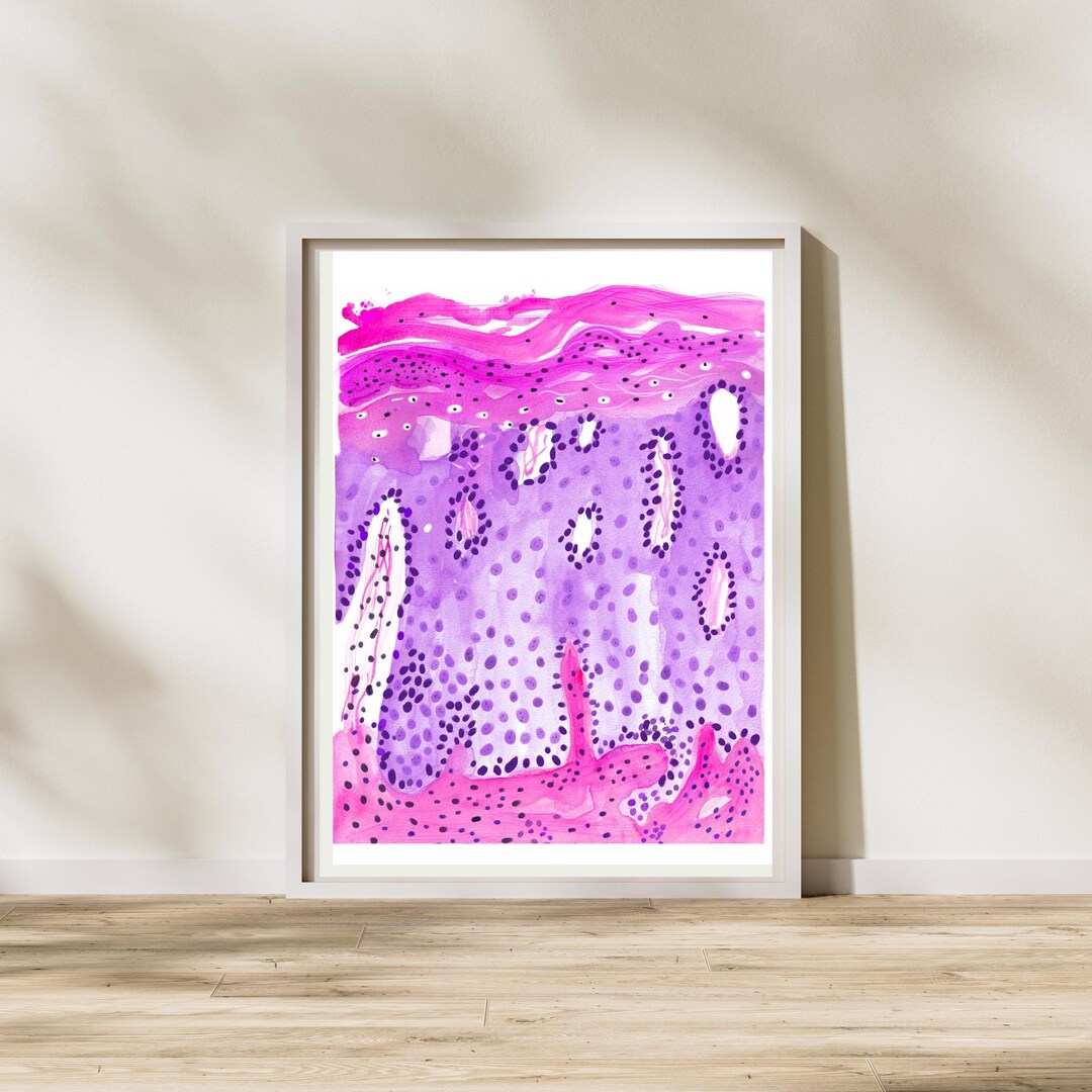 Psoriasis - Skin Histology Pathology Art, Dermatology Office Art ...