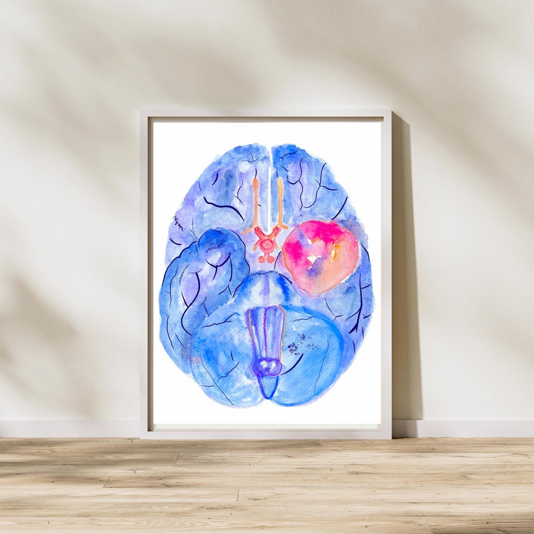 Meningioma Brain Art, Neurology Art, Neurosurgery and Neuropathology ...