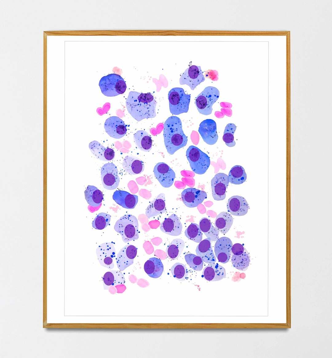 Multiple Myeloma, Pathology Art, Laboratory Art, Oncology Art ...