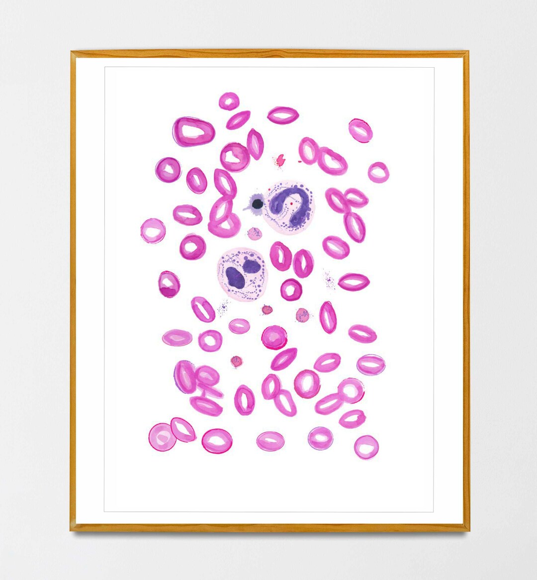 Sickle Cell Anaemia, Anemia Art, Hematology Art, Hematologist Gift ...