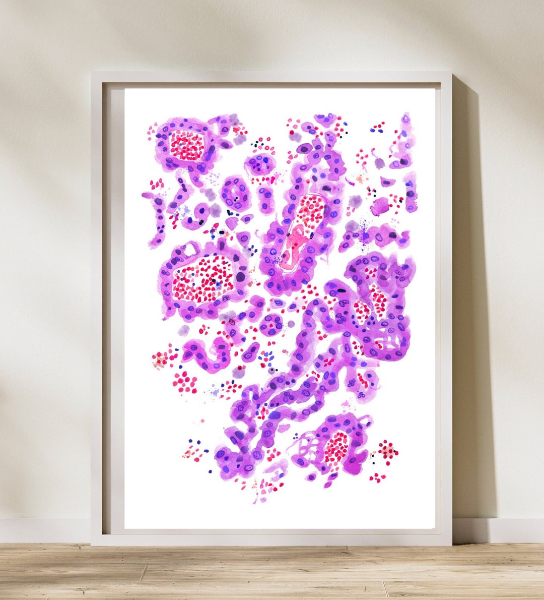 Lung Papillary Adenocarcinoma, Pathology Art, Oncology Art, Lung Cancer ...