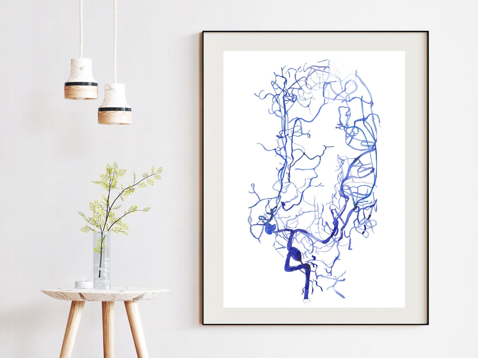 Brain Aneurysm Print Cerebral Aneurysm Art Print Angiogram - Etsy
