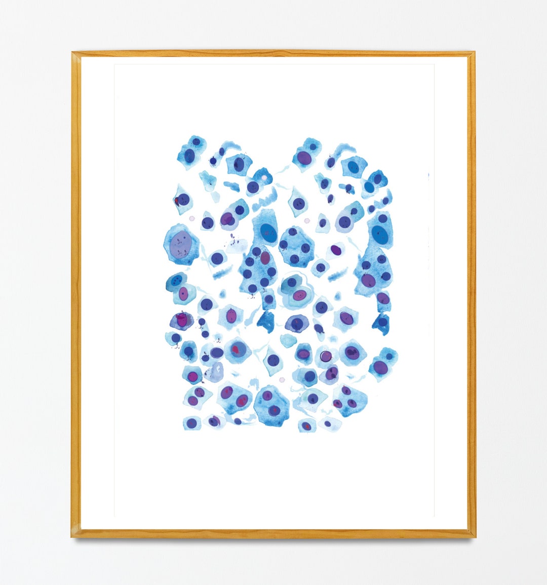 Skin Pathology Art, Melanoma Art Print, Pathology Art Print, Laboratory ...