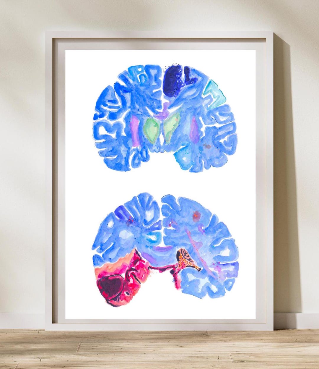 Stroke, Neurology Art, Neurologist Gift, Neurosurgery, Pathology Art ...
