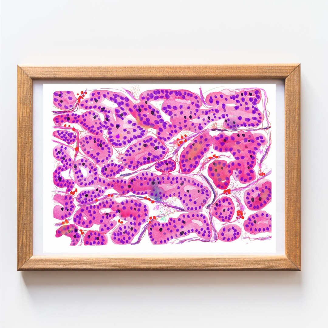 Hepatocellular Carcinoma Histopathology Art - Oncology and Pathology ...