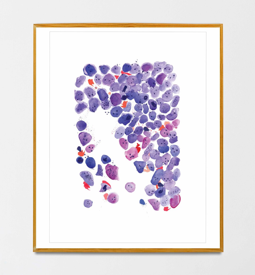 Acute Myeloid Leukemia Art Print, Hematopathology Art, Hematologist ...