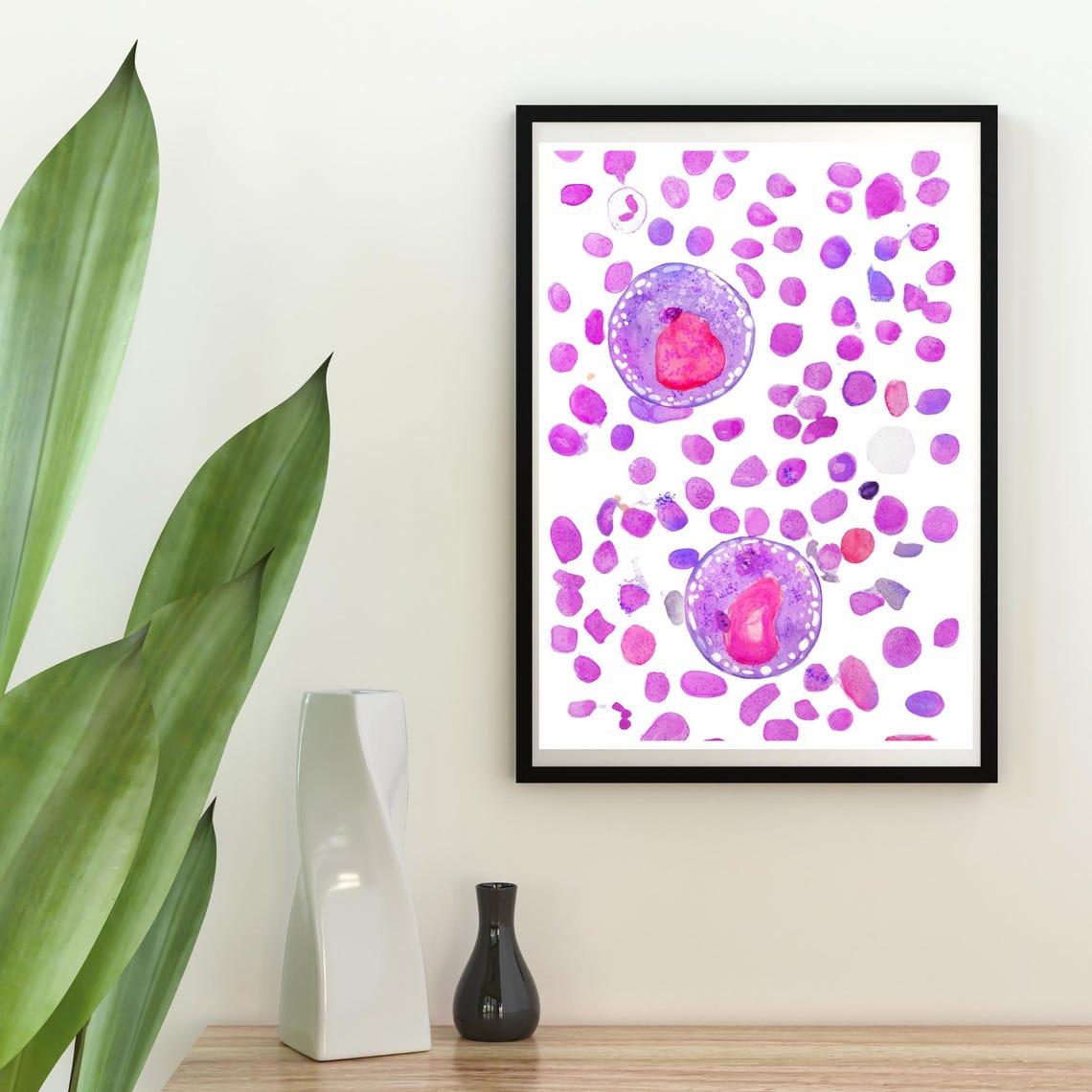 Hodgkin Lymphoma, Pathology Art, Oncology Art, Pathology Artwork ...