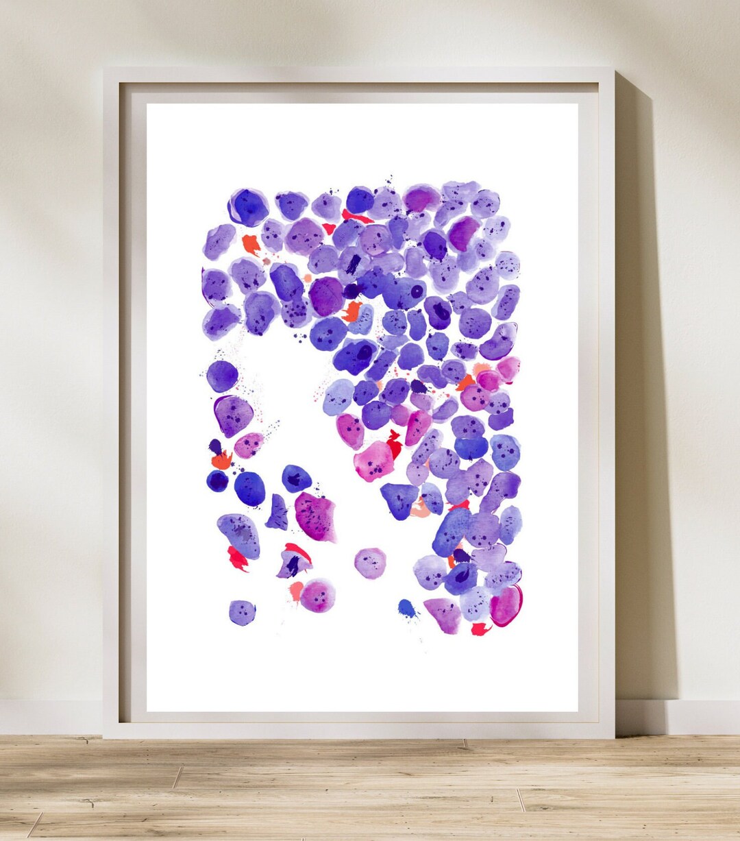 Acute Myeloid Leukemia Art Print, Hematology Art, Hematologist Office ...
