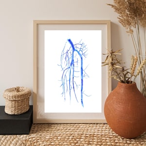 Popliteal Tibial Angiography, Lower Limb DSA, Radiology Art, Vascular ...