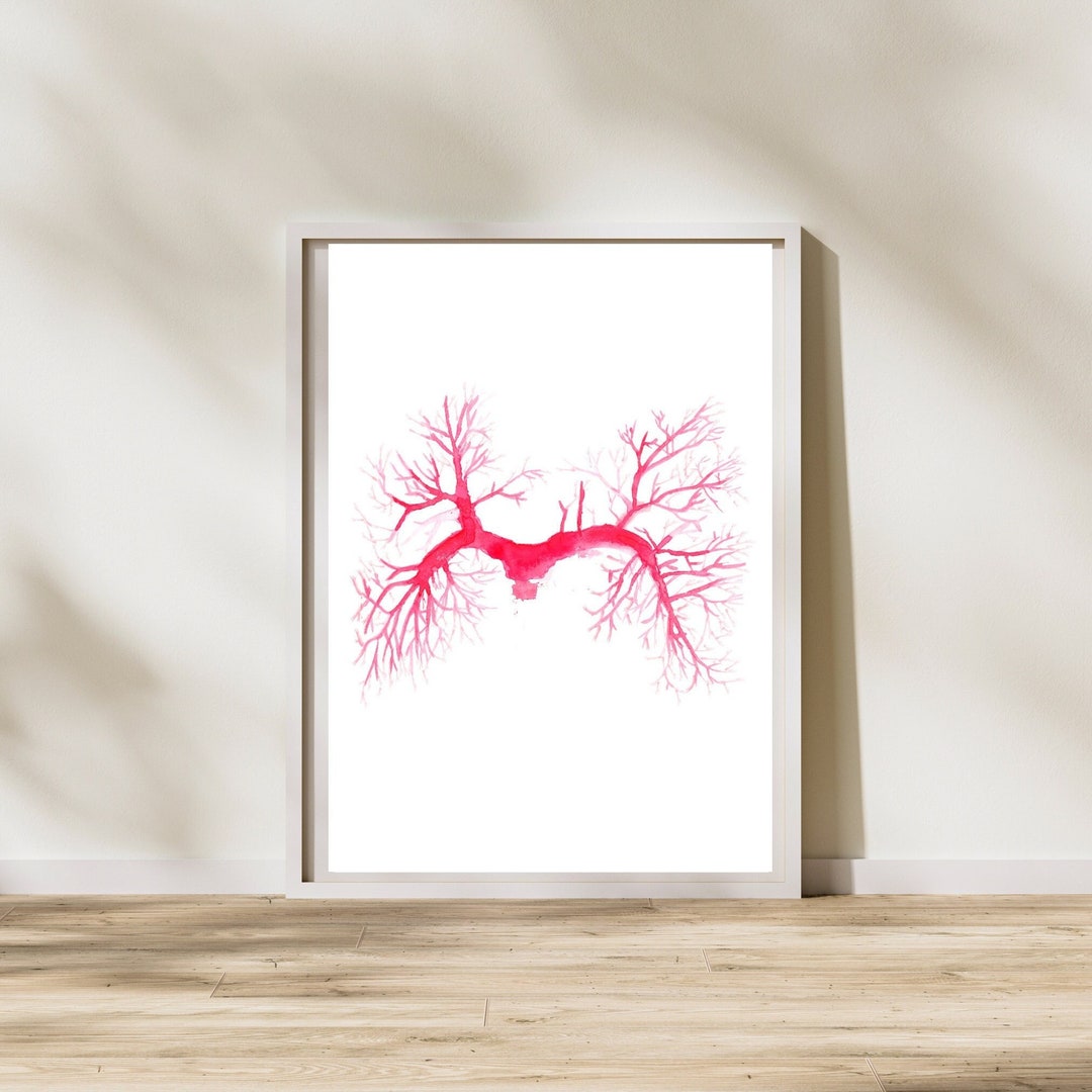 Pulmonary Embolism, Angiogram, Radiology Art, Pulmonary Medicine ...
