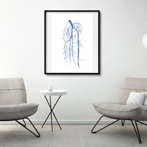 Popliteal Tibial Angiography, Lower Limb DSA, Radiology Art Print ...