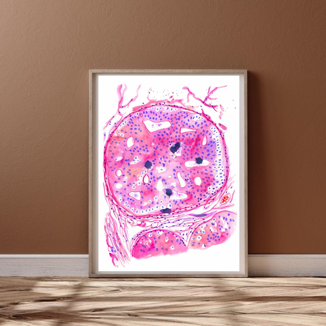 Breast Cancer - Pathology Art - Breast Pathology Gift, Histology Art ...