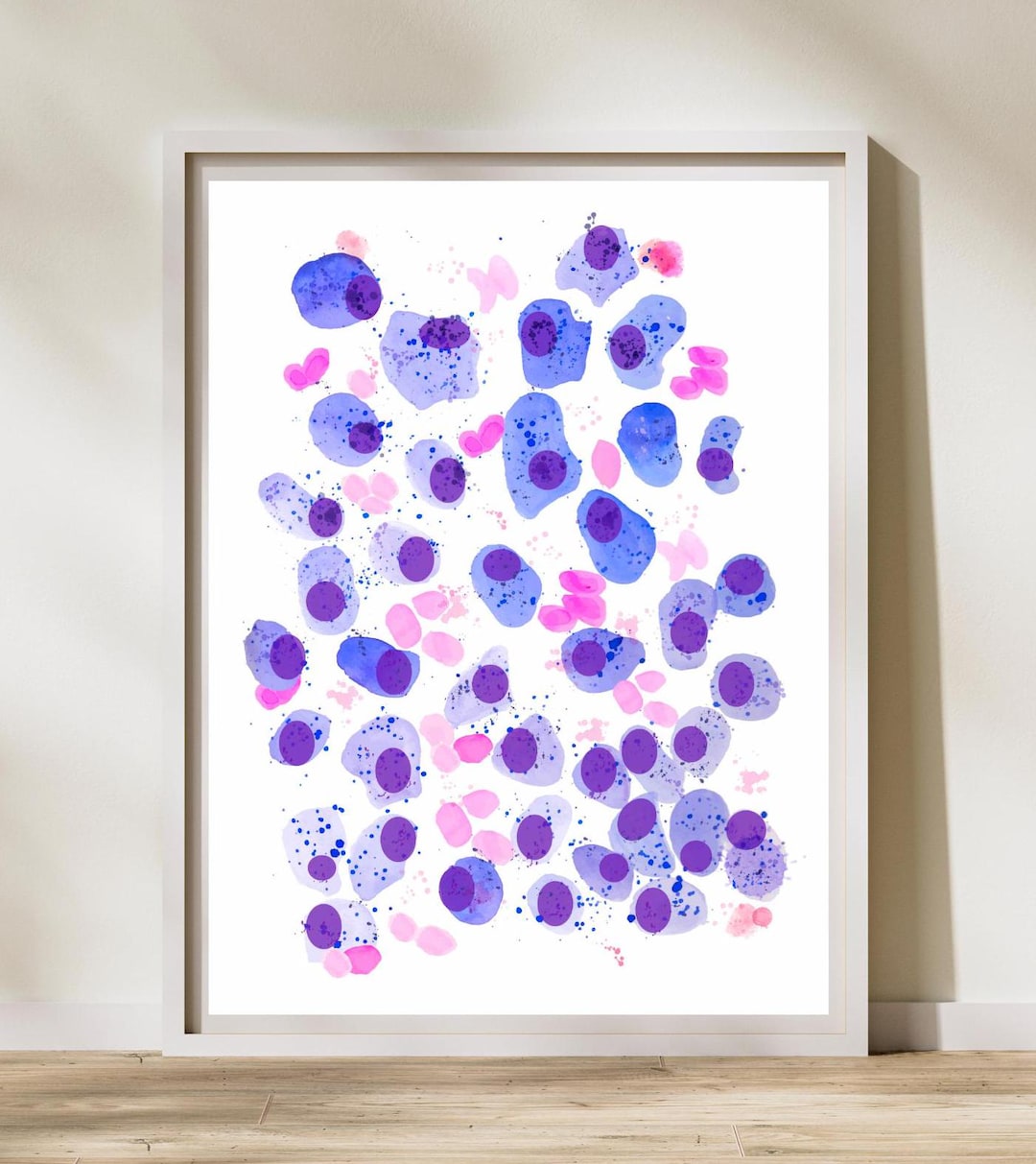 Multiple Myeloma, Pathology Art, Laboratory Art, Oncology Art ...