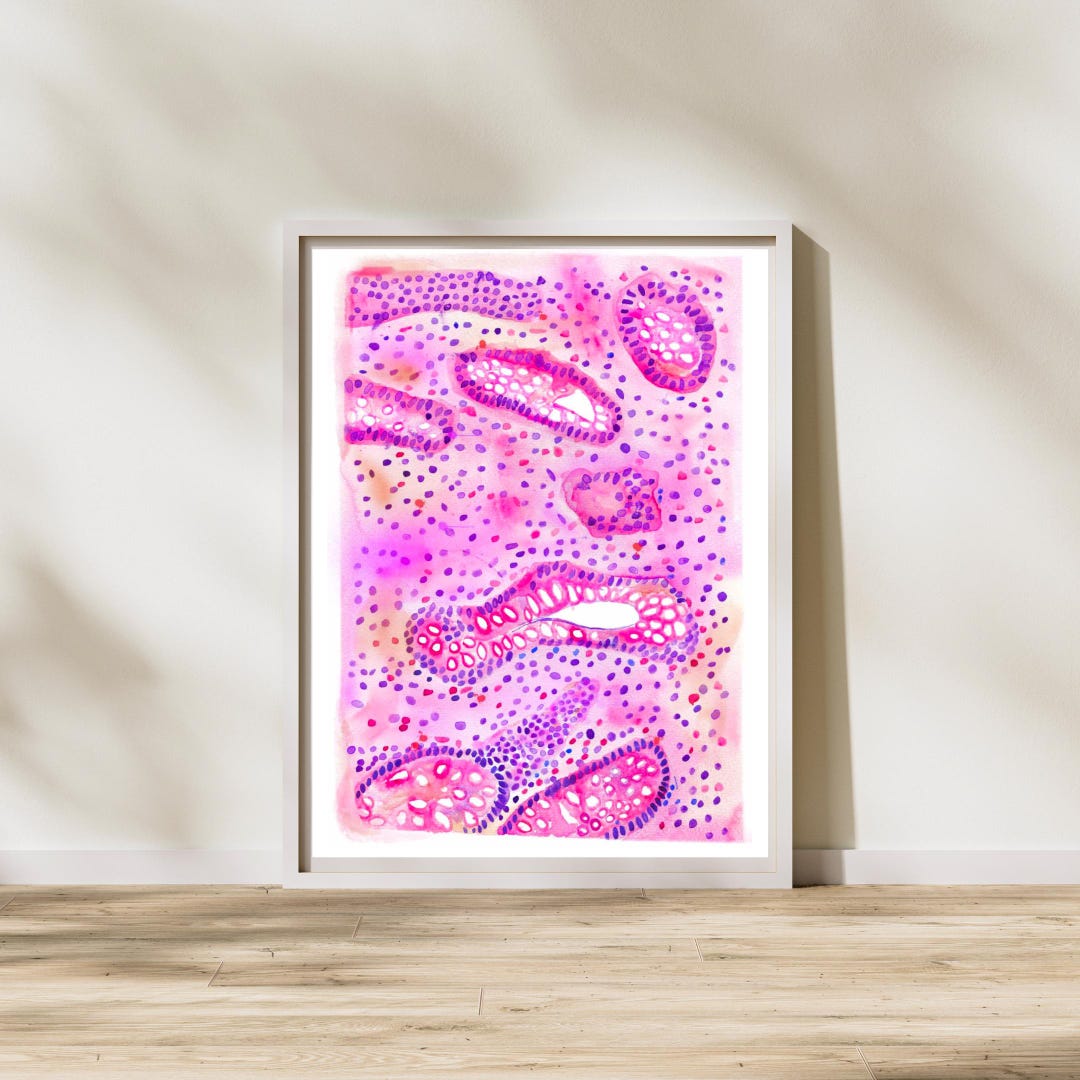 Ulcerative Colitis - Pathology Art, Endoscopy Artwork, Gastroenterology ...