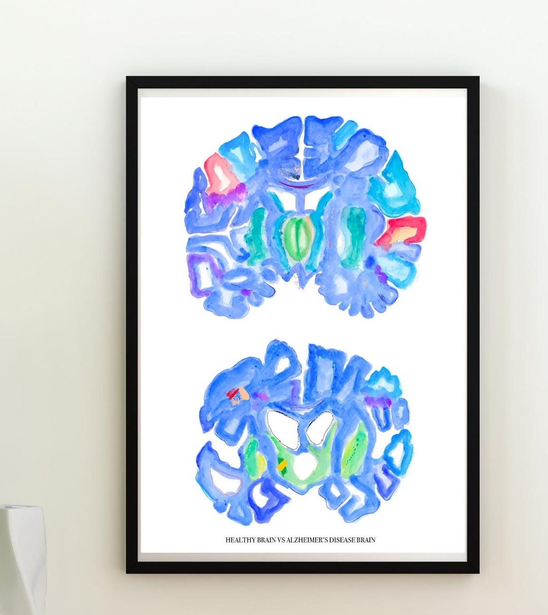 Alzheimer's, Neurology Art, Neurology Brain Art, Gift for Neurologists ...