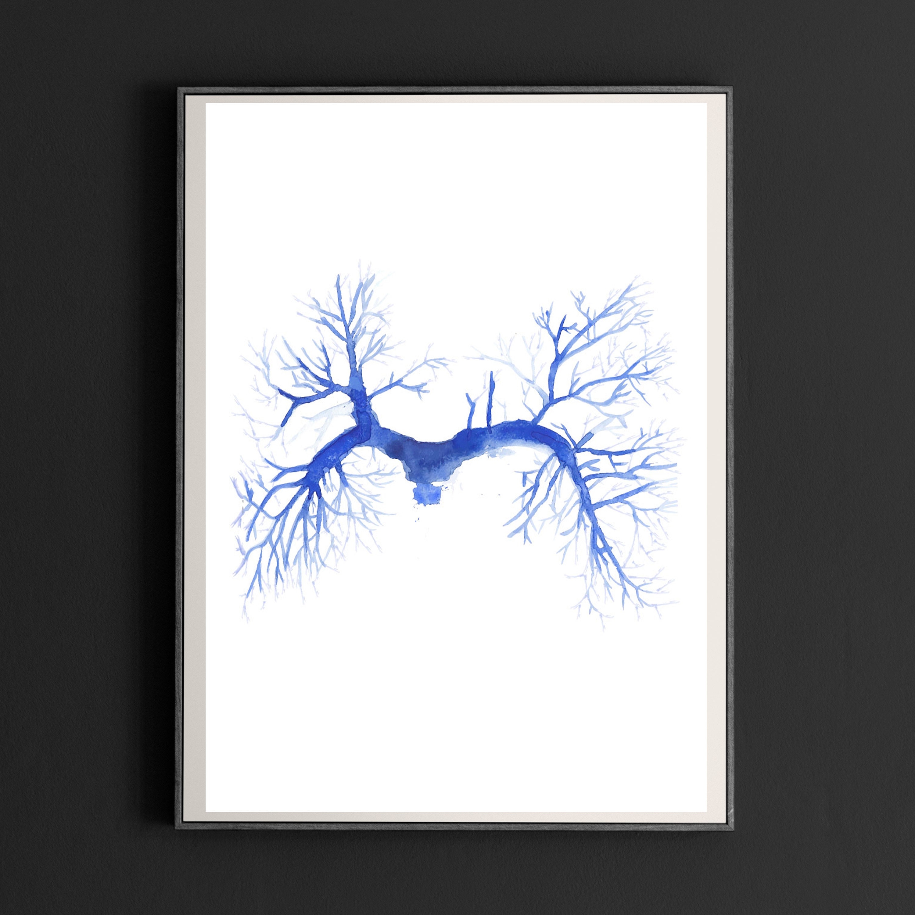 Pulmonary Embolism Angiography CT Angio Radiology Art Print - Etsy