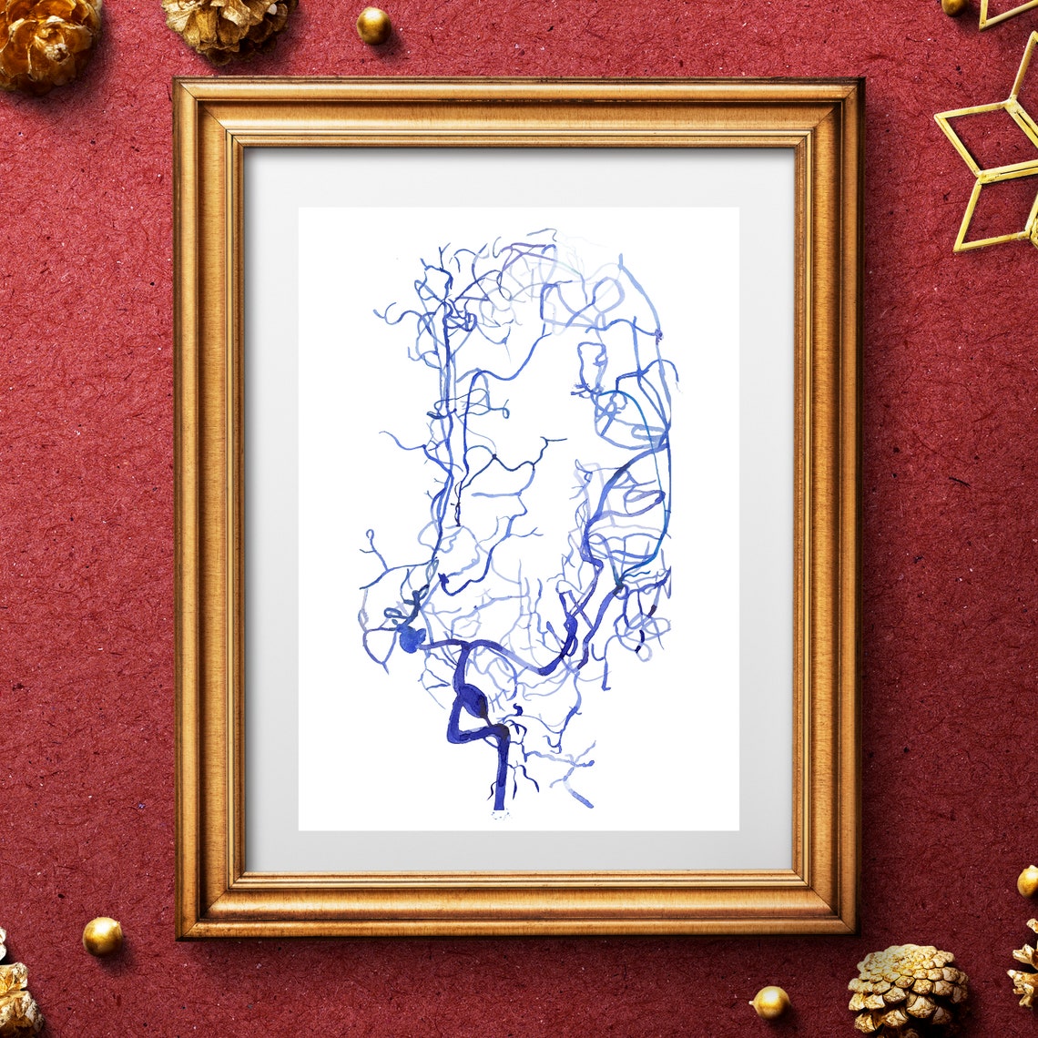 Brain Aneurysm Print Cerebral Aneurysm Art Print Angiogram - Etsy