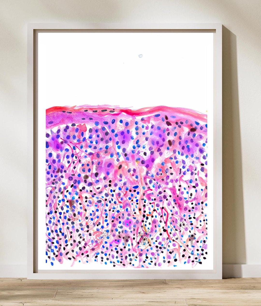 Melanoma, Skin Cancer Awareness, Histopathology Art, Histology Artwork ...
