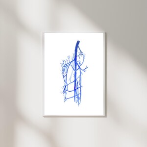 Popliteal Tibial Angiography, Lower Limb DSA, Radiology Art Print ...