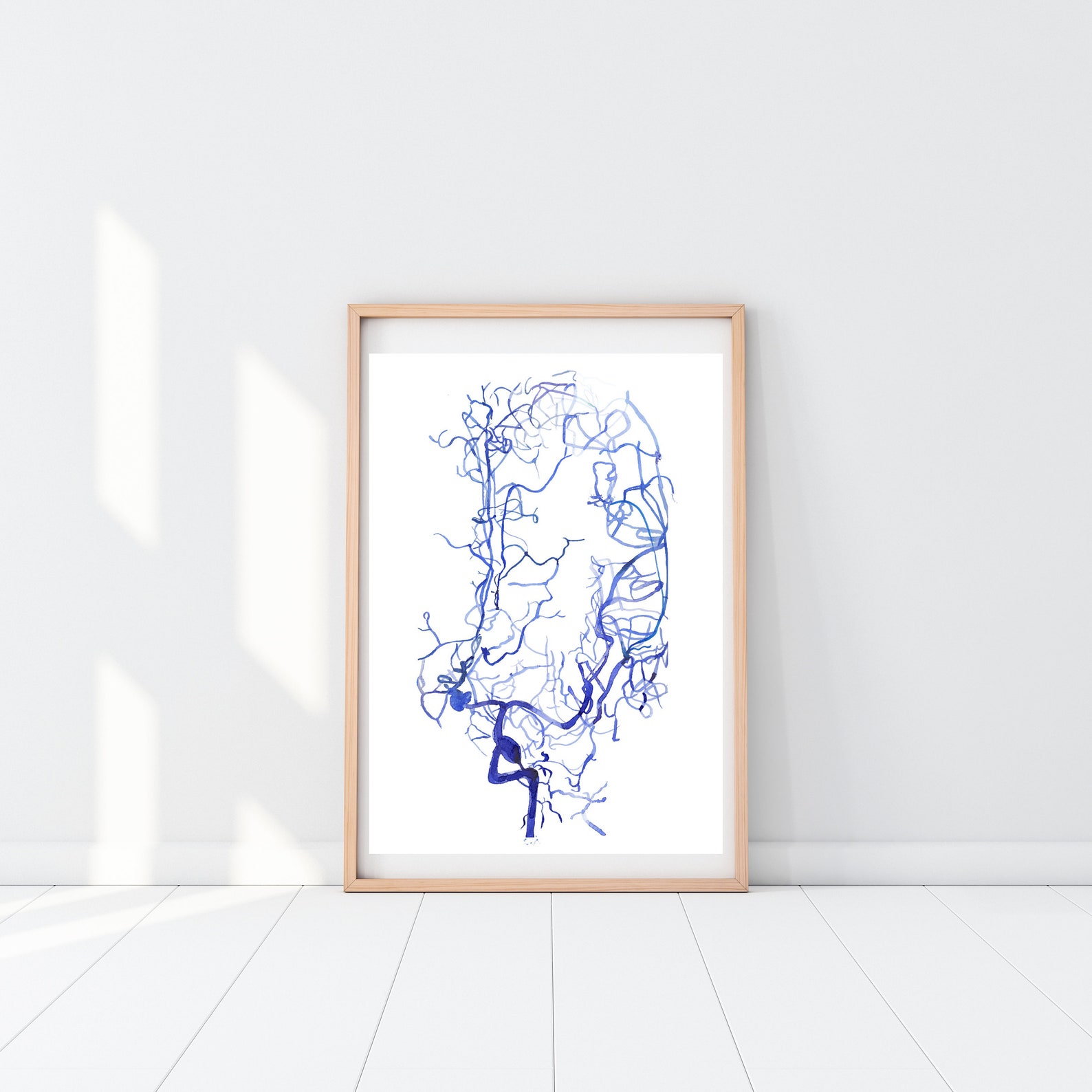 Brain Aneurysm Print Cerebral Aneurysm Art Print Angiogram - Etsy