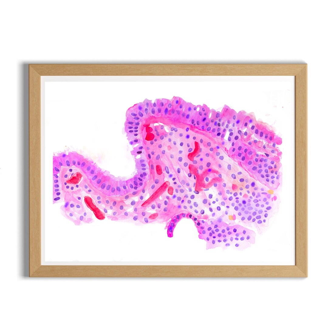 Pathology Art - Barretts Esophagus, Pathology Art, Pathology Assistant ...
