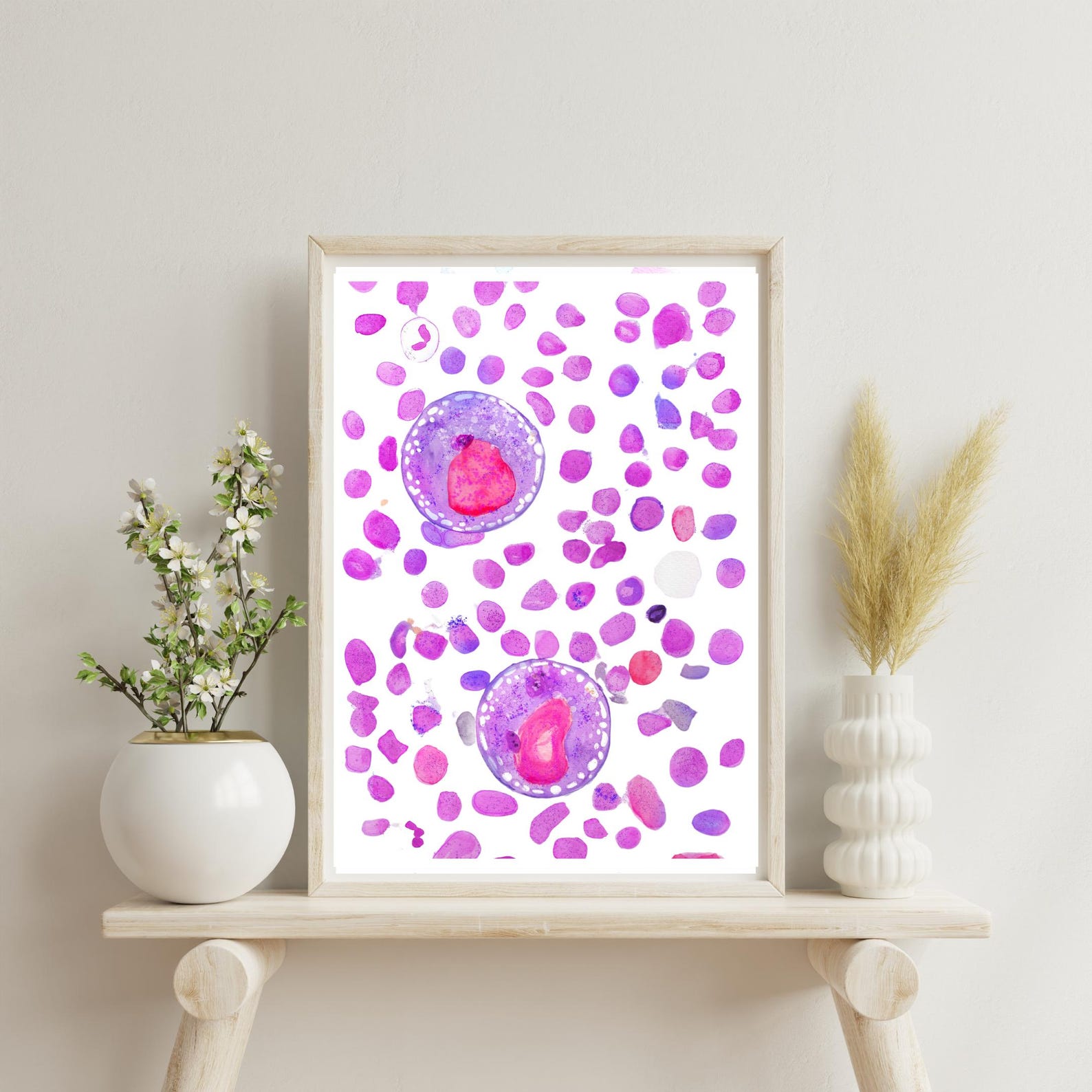 Hodgkin Lymphoma, Pathology Art, Oncology Art, Pathology Artwork ...